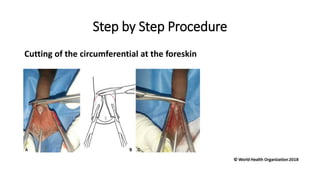 Male Circumcision under Local Anaesthesia by Dr Grothuesmann & Sr Winie ...