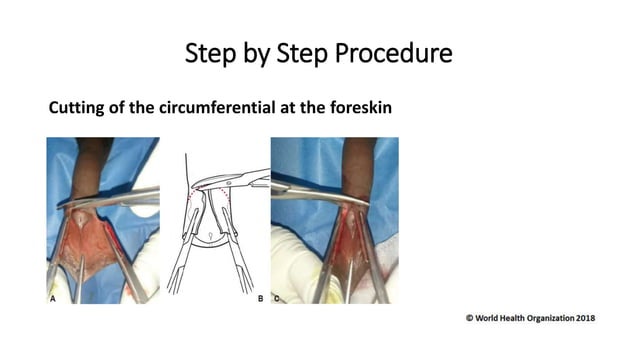 Male Circumcision under Local Anaesthesia by Dr Grothuesmann & Sr Winie ...