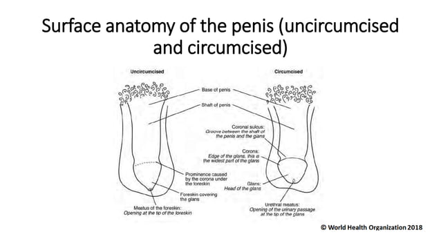 Male Circumcision under Local Anaesthesia by Dr Grothuesmann & Sr Winie
