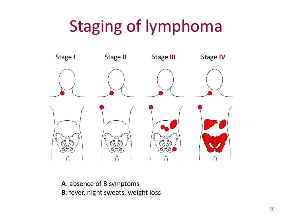 Hodgkin's Lymphoma