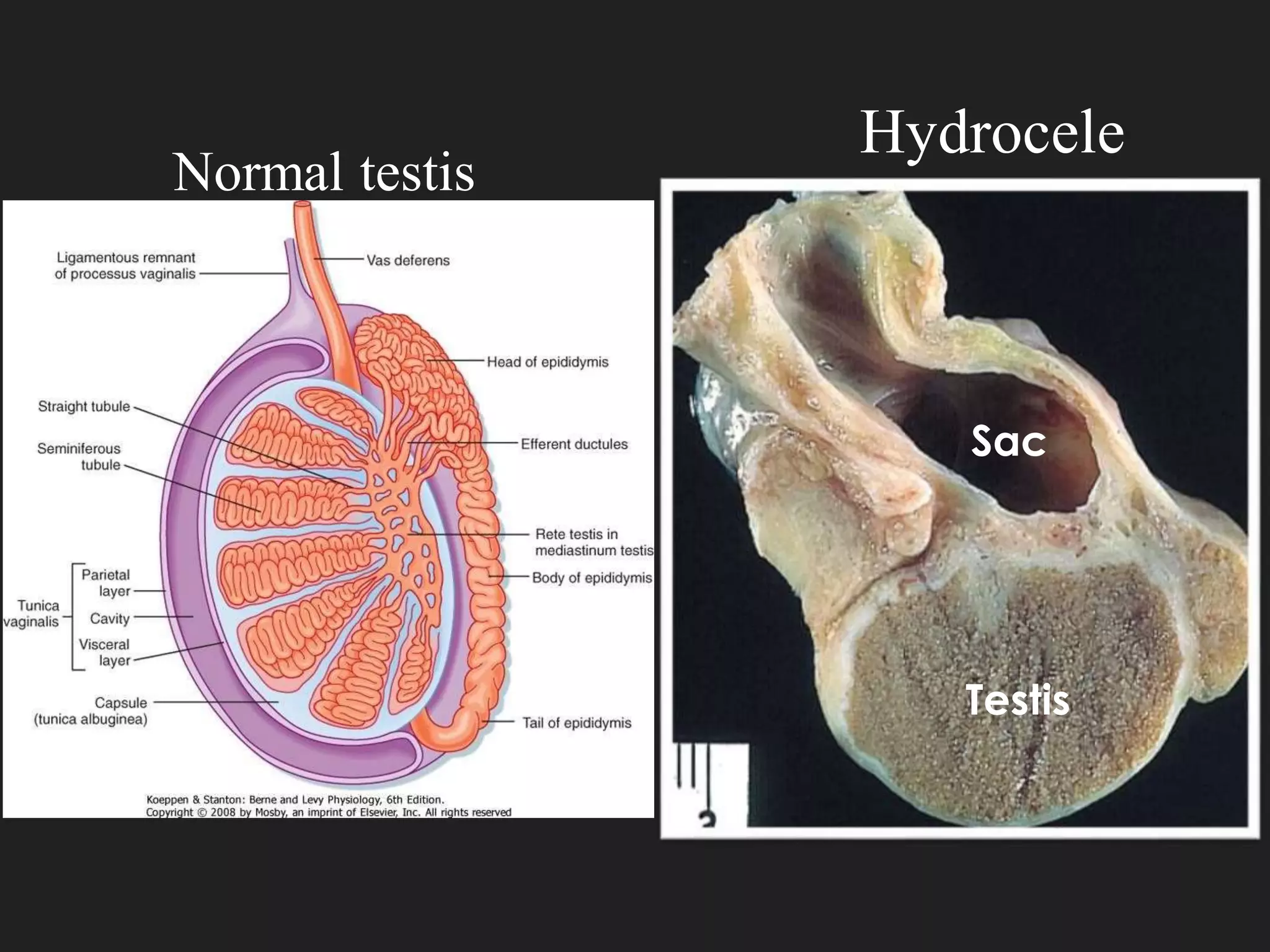 Pathology of Lower Urinary Tract & Male Genital System | PDF