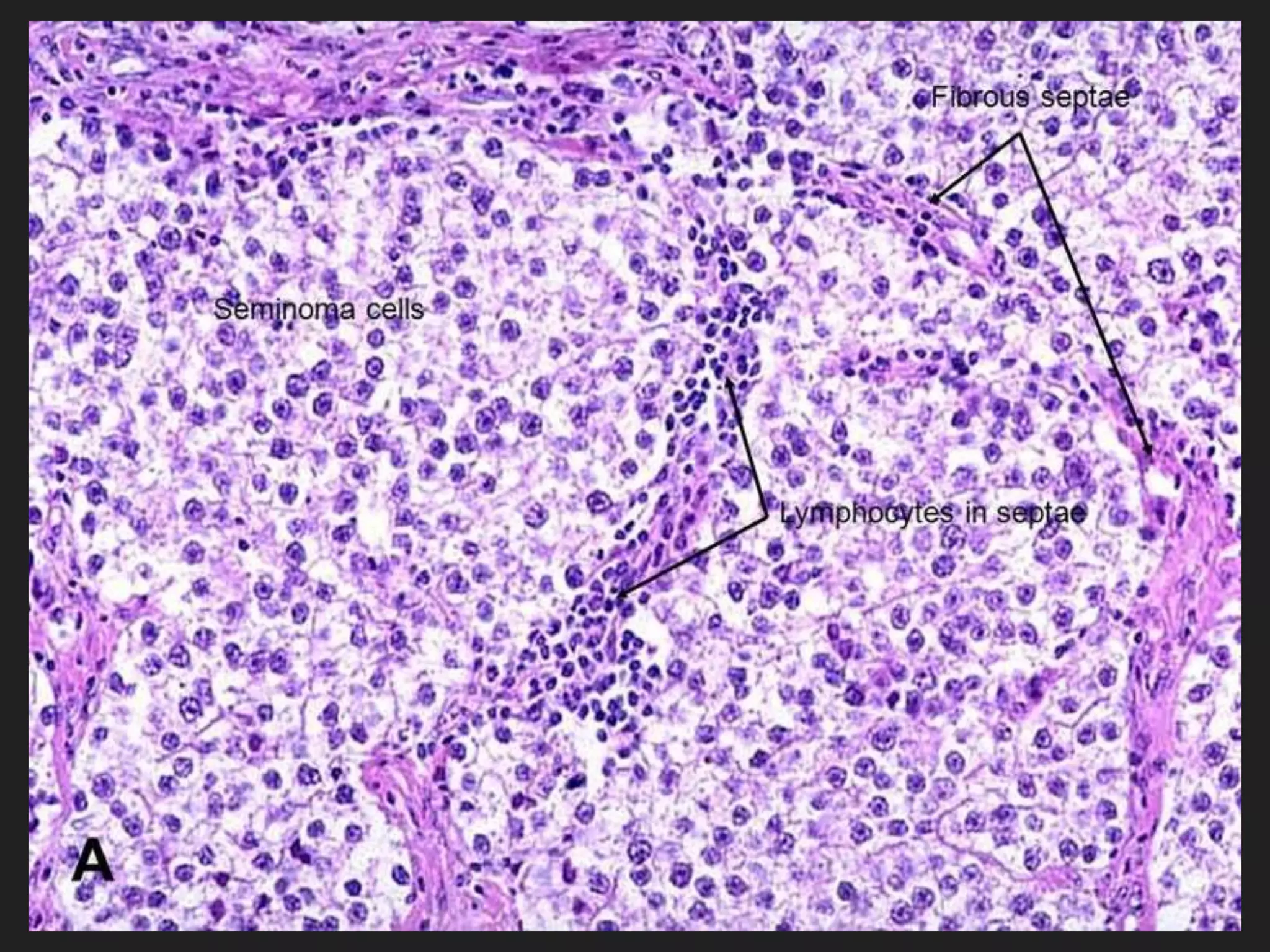 Pathology of Lower Urinary Tract & Male Genital System | PDF