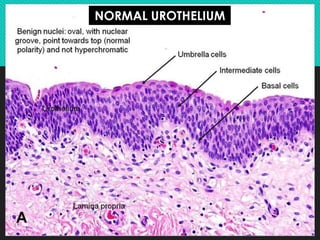 Pathology of Lower Urinary Tract & Male Genital System | PDF