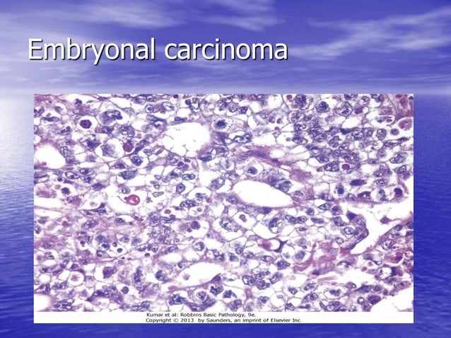 Male genital tract pathology lab | PPT Male genital tract pathology lab | PPT