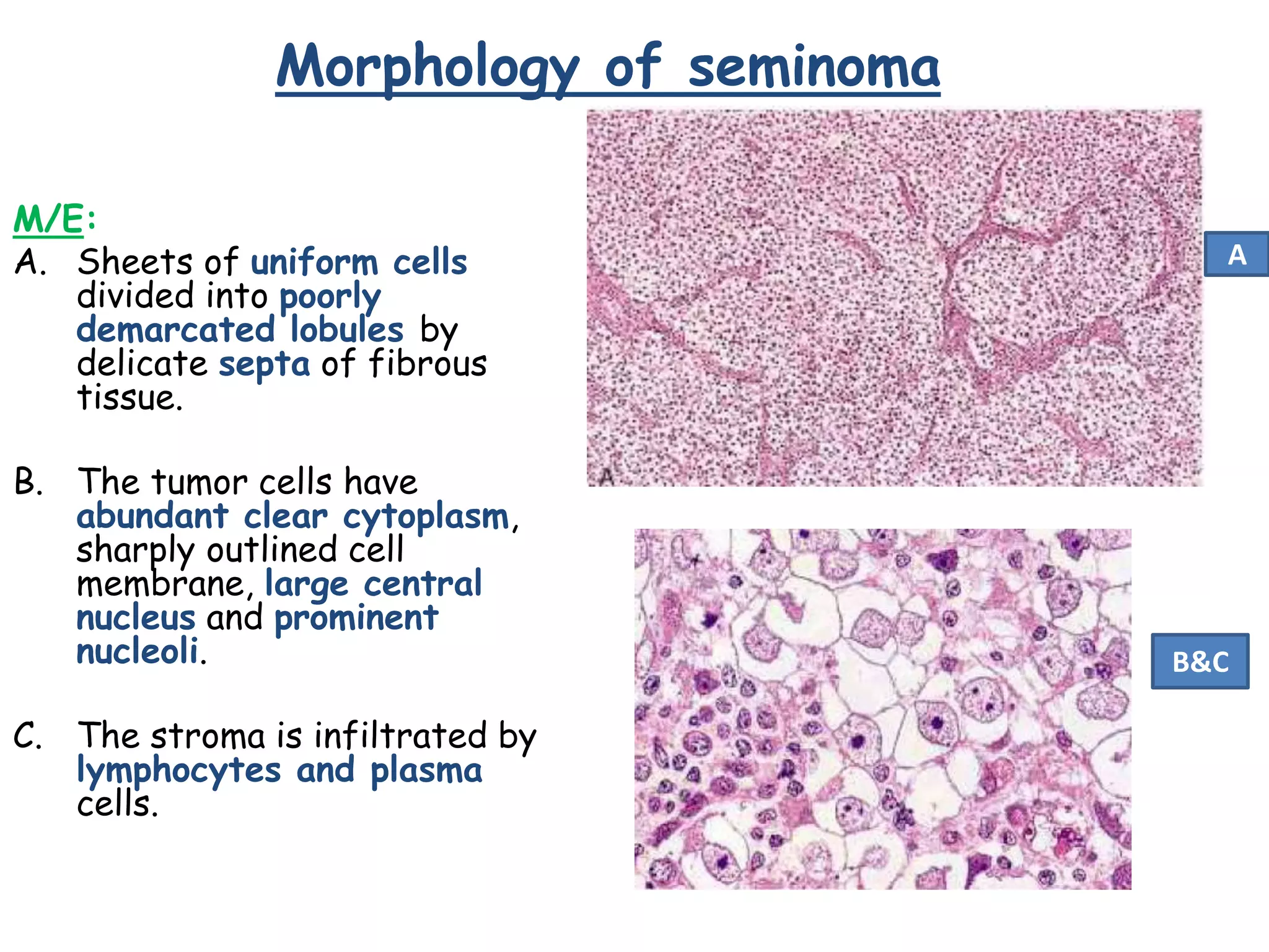 Hydrocele and testicular tumor | PPTX