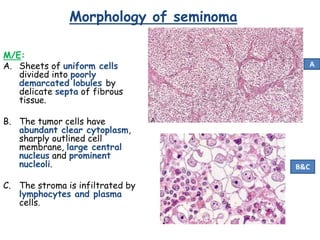 Hydrocele and testicular tumor | PPTX