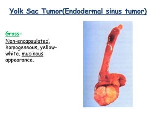 Yolk Sac Tumor Gross