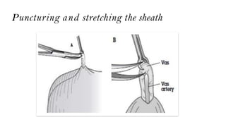 Male Sterilization methods widely used in this era | PPTX