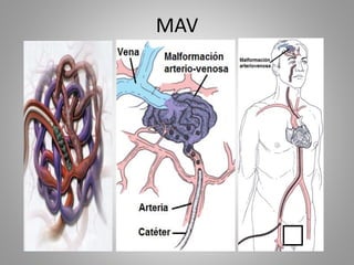 Malformacion arteriovenosa | PPTX