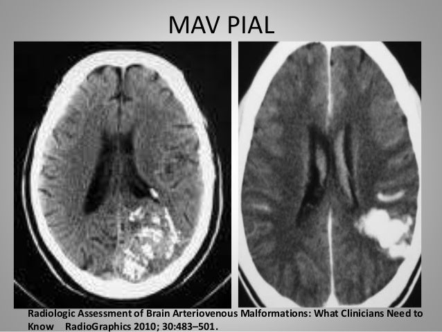 Malformacion arteriovenosa