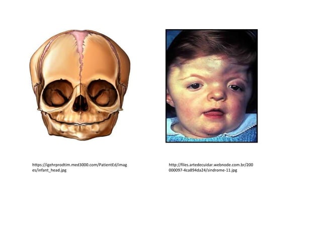 Malformacion congenita de hueso | PPT