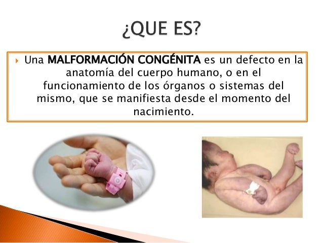 Malformacion congenitas