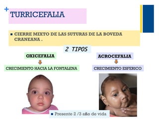 Malformaciones Craneofaciales No Sindromicas y Sindromicas. | PDF