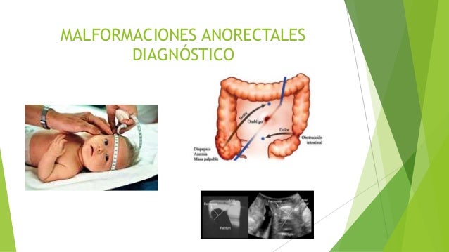 Malformaciones anorrectales