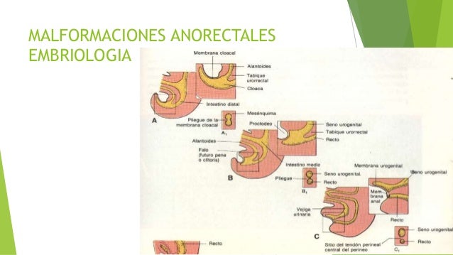 Malformaciones anorrectales
