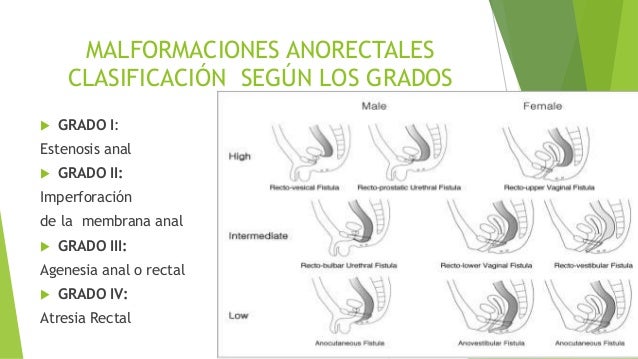 Malformaciones anorrectales