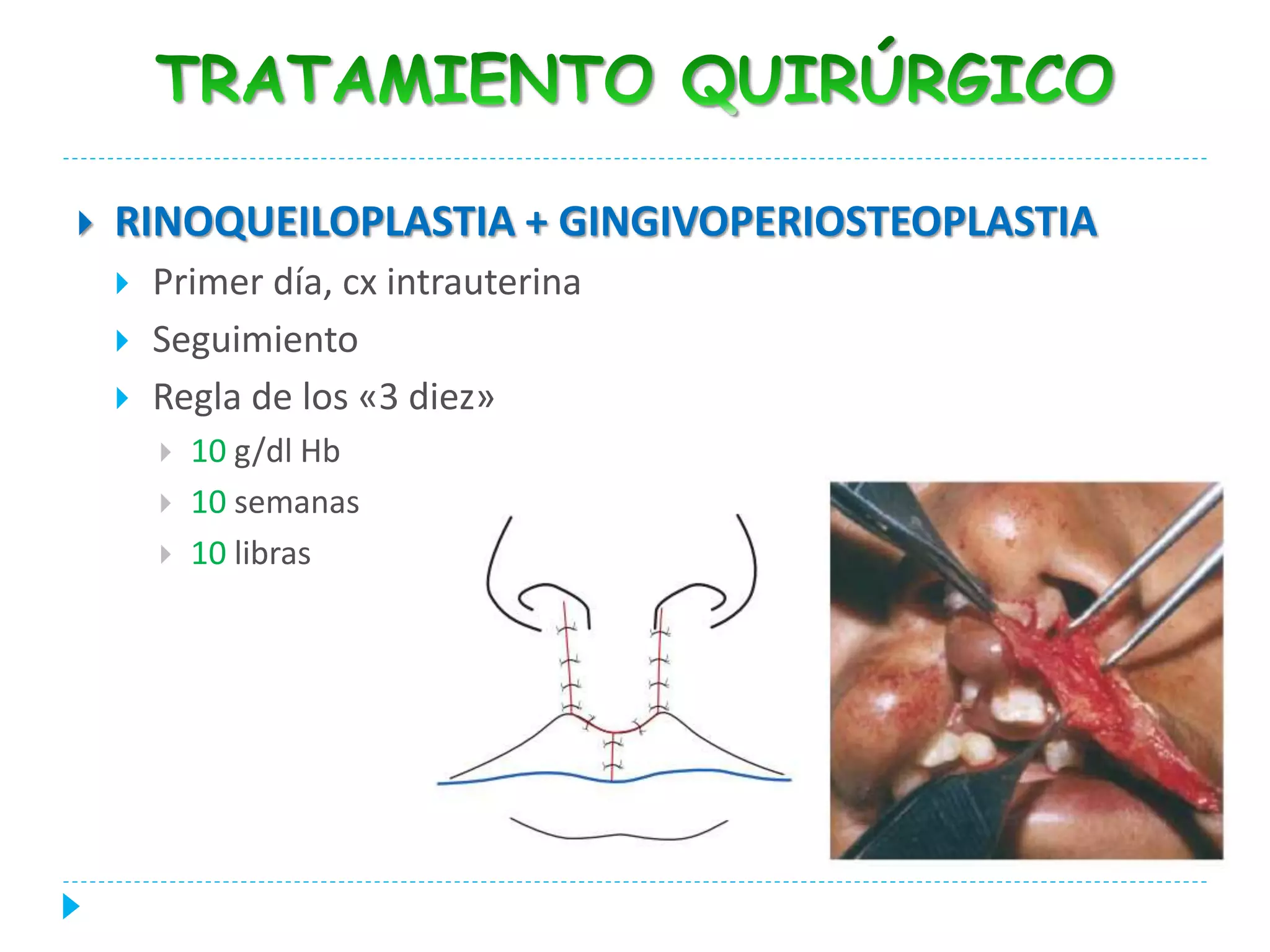 Labio y paladar hendido | PPTX