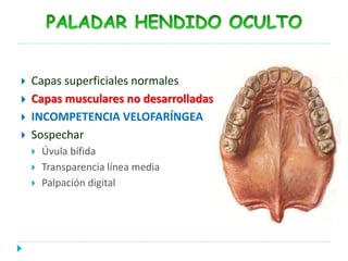 Labio y paladar hendido | PPTX