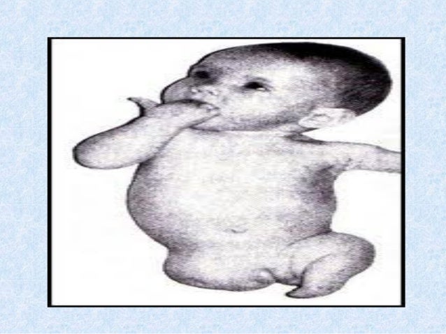 Malformaciones congenitas del hueso