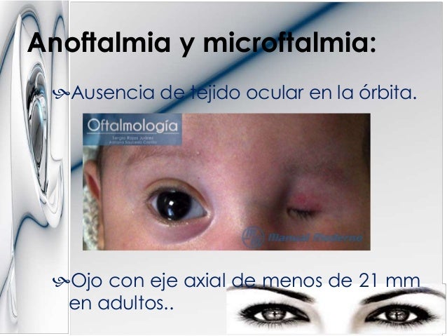 Malformaciones congénitas de globo ocular, párpados y vía lagrimal.