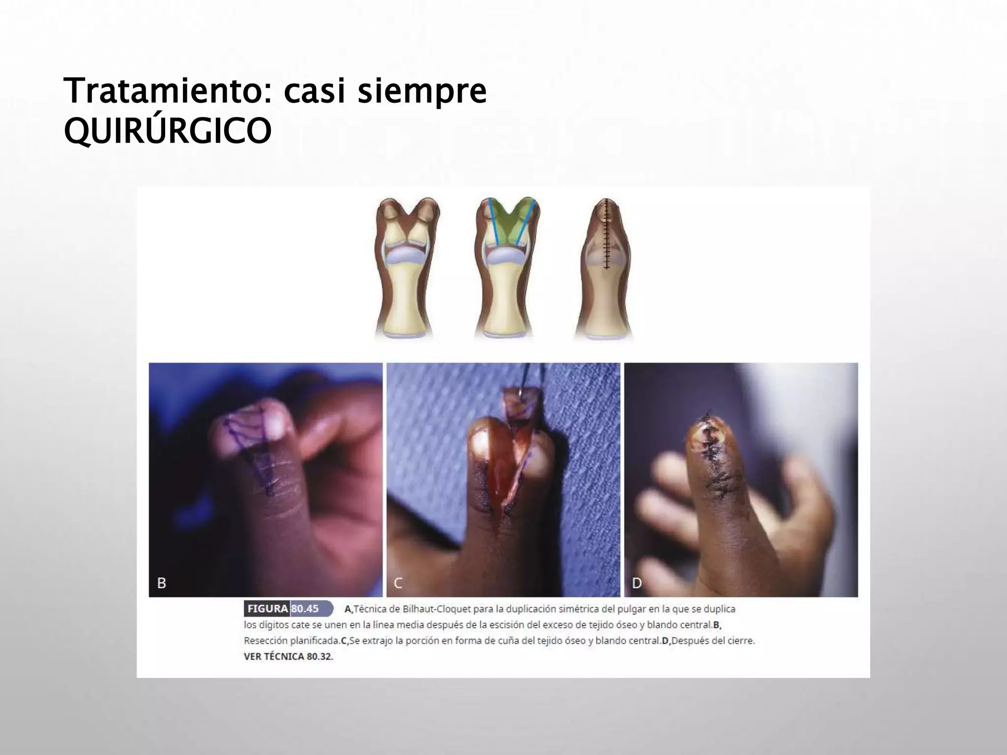 Malformaciones congénitas de la mano.pptx
