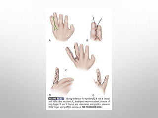 Malformaciones congénitas de la mano.pptx