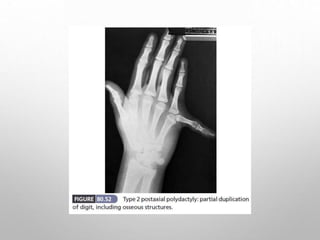 Malformaciones congénitas de la mano.pptx