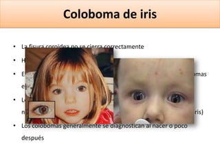 Malformaciones congénitas del ojo | PPTX