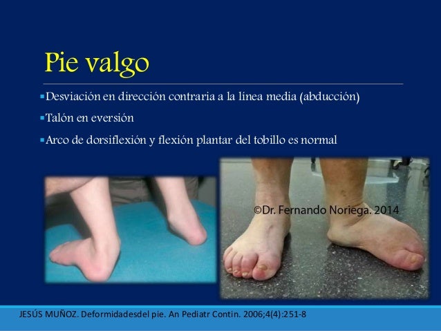 Deformaciones congénitas del Pie