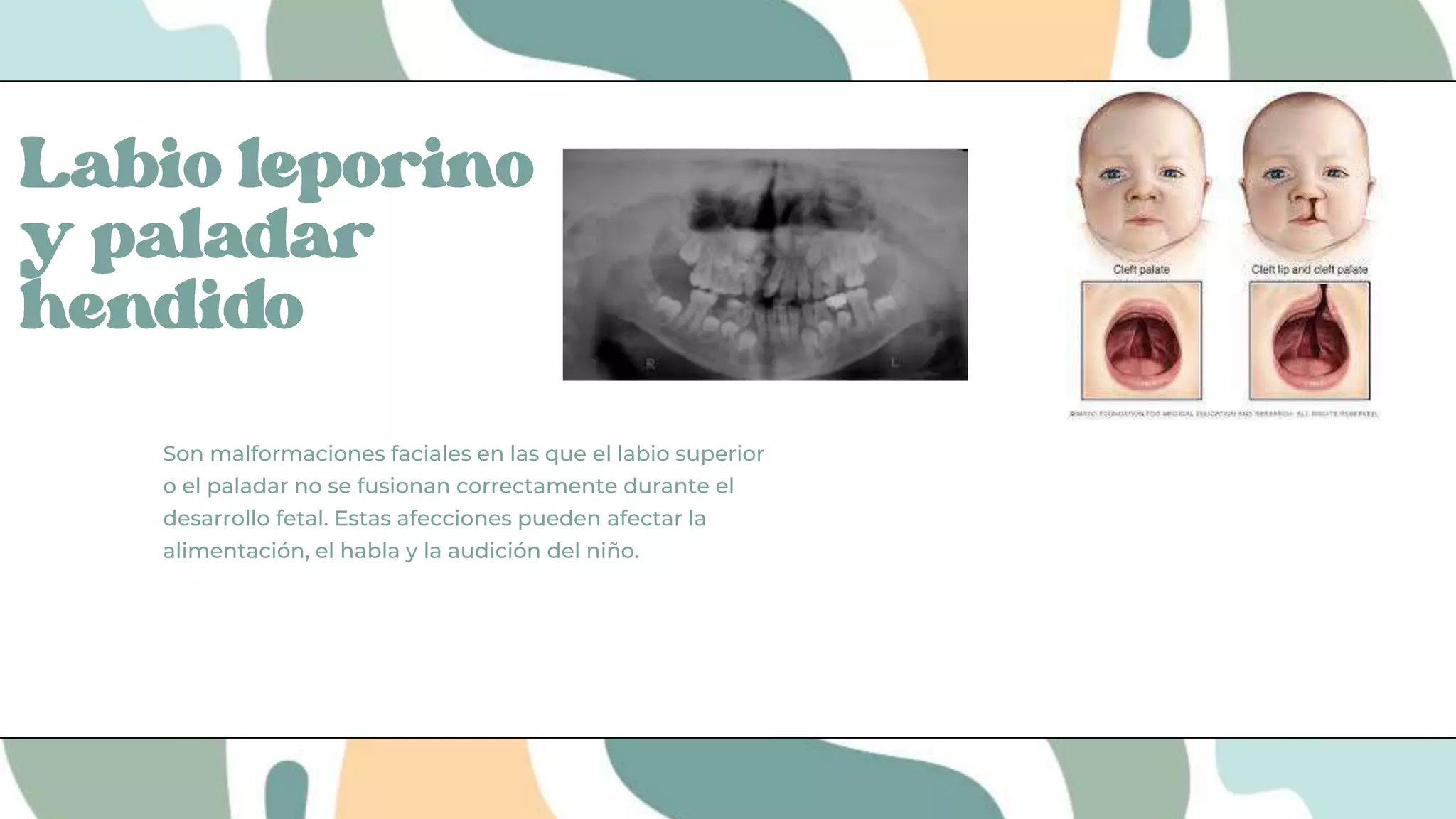 Malformaciones craneofacial congenitas.pptx
