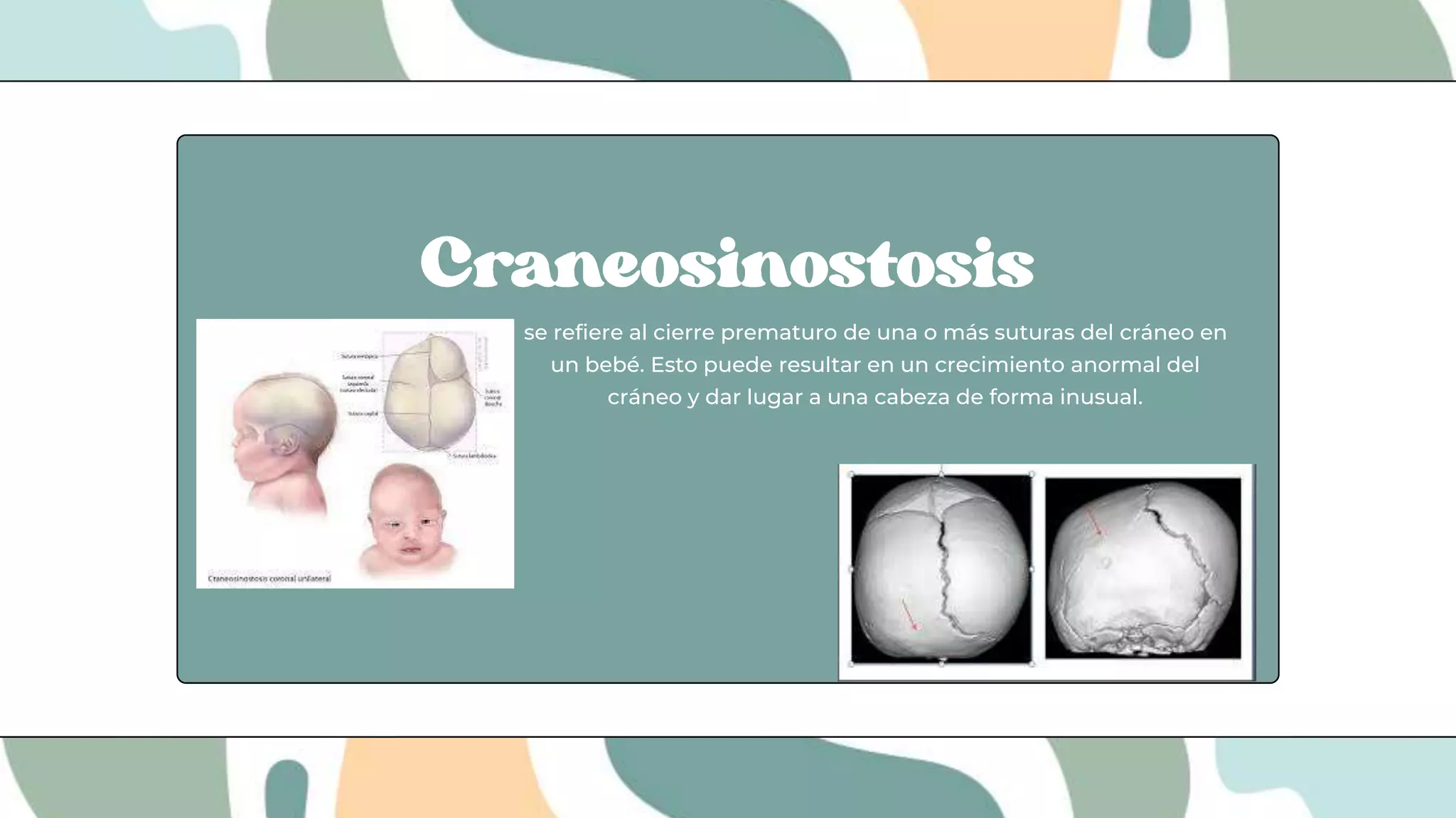 Malformaciones craneofacial congenitas.pptx