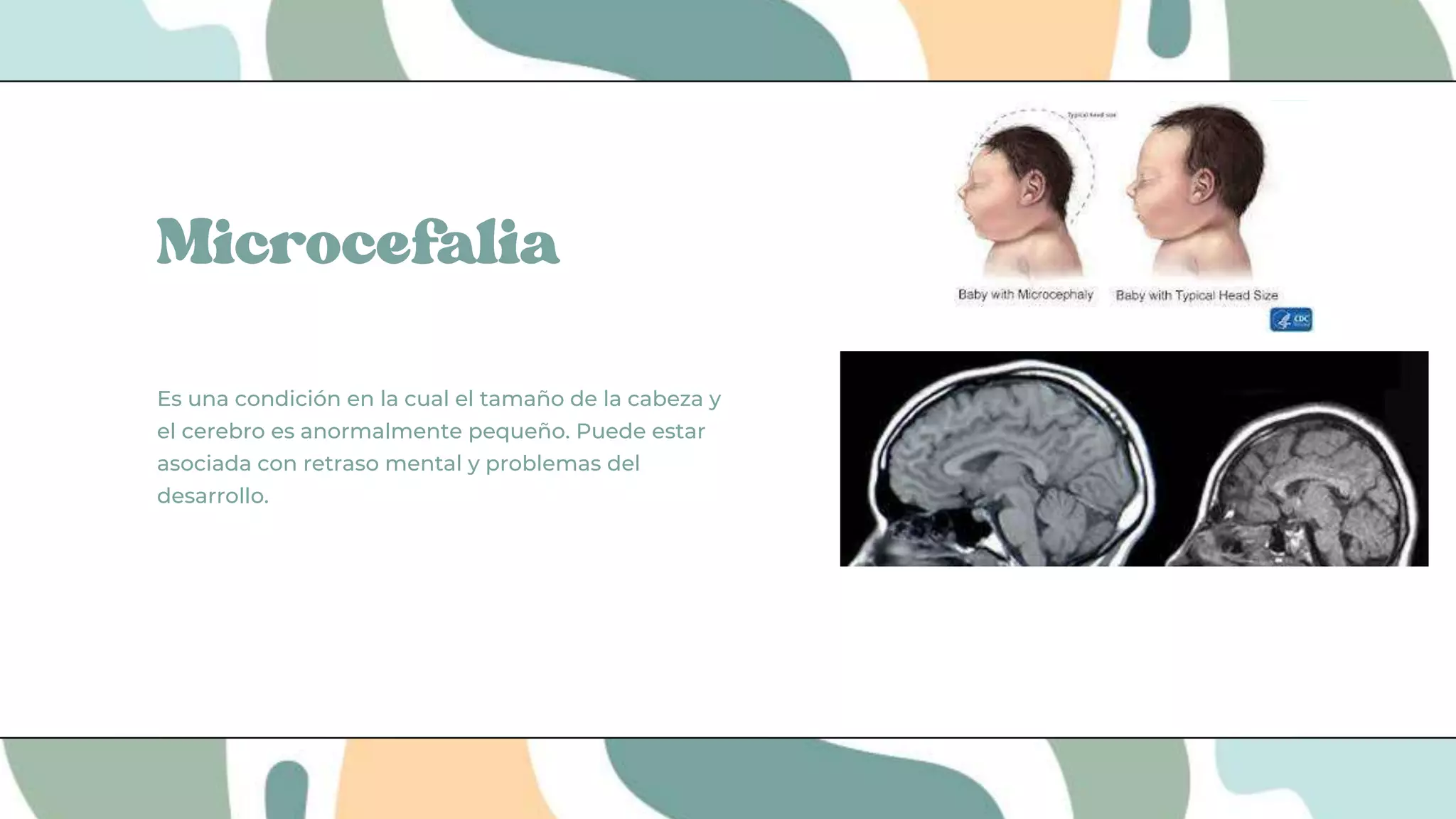 Malformaciones craneofacial congenitas.pptx