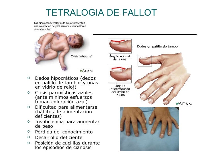 Malformaciones de cardio Sistema Cardiaco - Embriología ERA 3