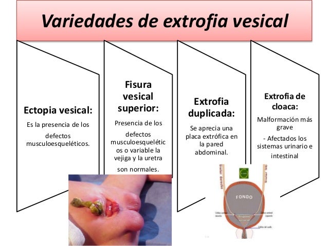Malformaciones de la vejiga y del uraco