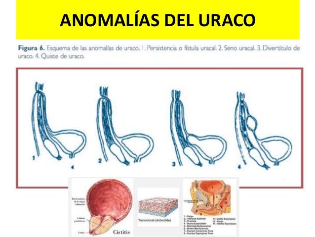 Malformaciones de la vejiga y del uraco