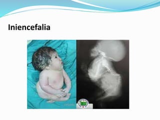 Malformaciones del cerebro | PPT