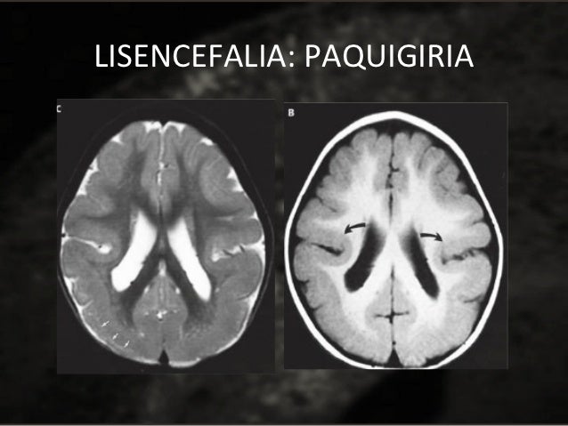 Malformaciones del desarrollo cortical y Epilspsia.