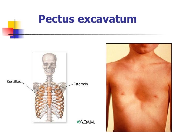 Malformaciones del tórax