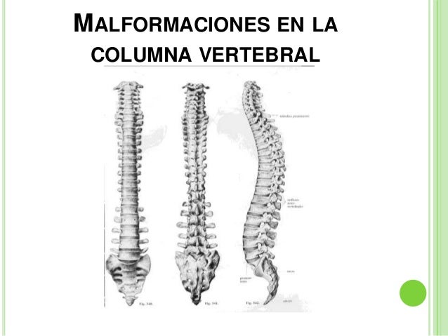 Malformaciones oseas