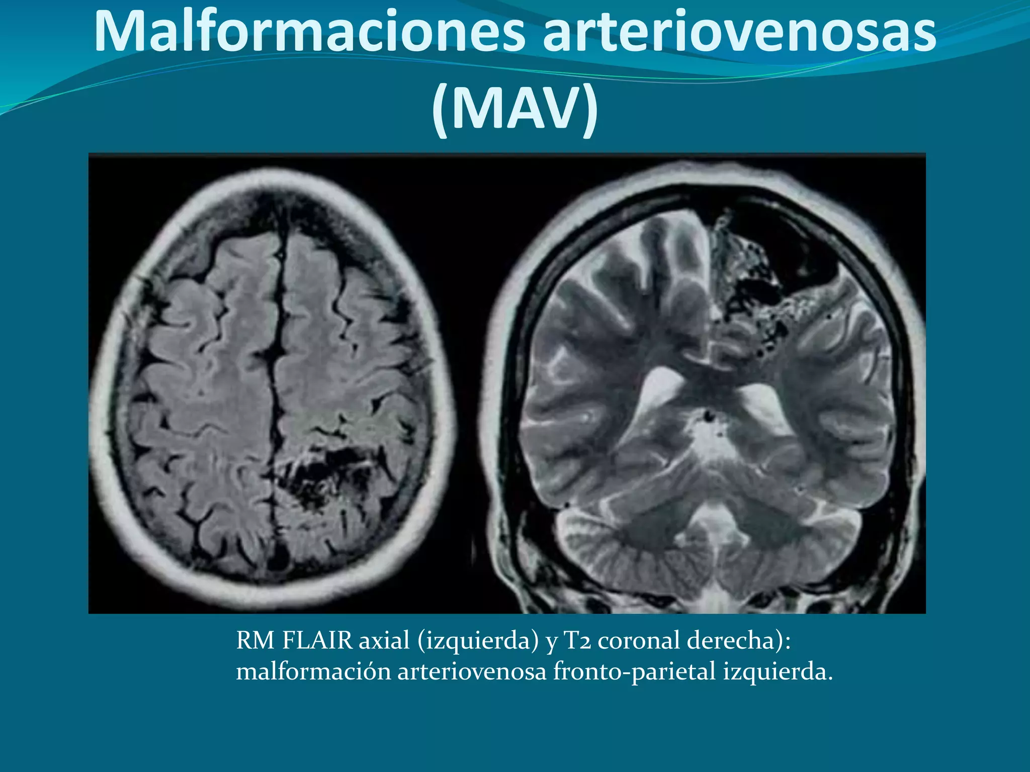 Malformaciones vasculares cerebrales