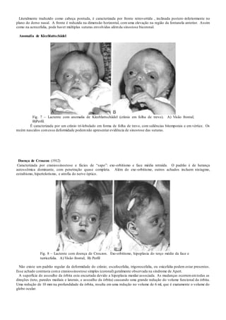 Malformações Craniofaciais | PDF