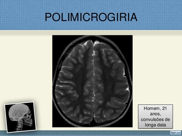 Malformações do desenvolvimento cortical
