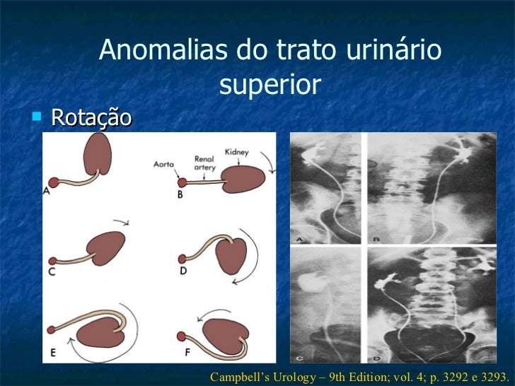 Malformações do trato urinário