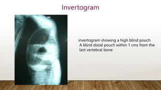 malformasi anorectal bedah anak.pptx