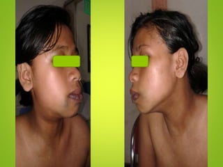 Malformasi vaskular | PPTX