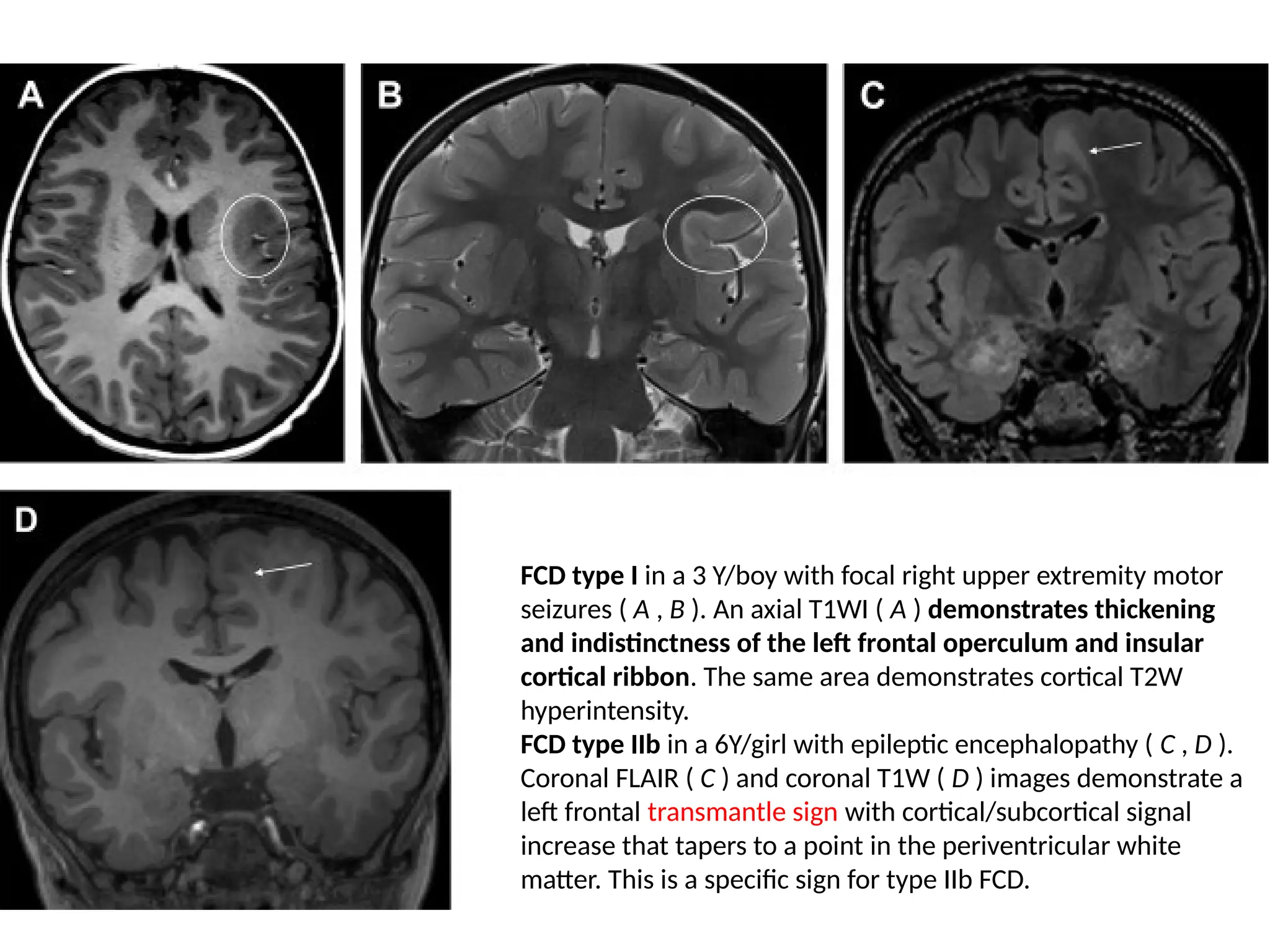 Malformations of Cortical Development.pptx