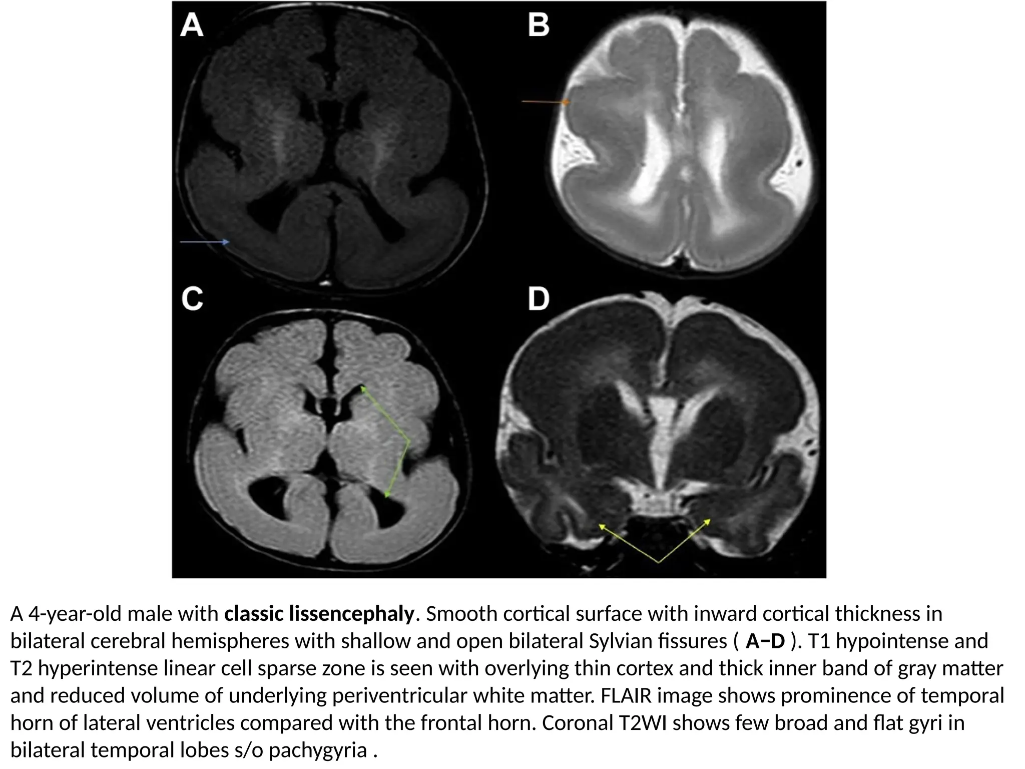 Malformations of Cortical Development.pptx