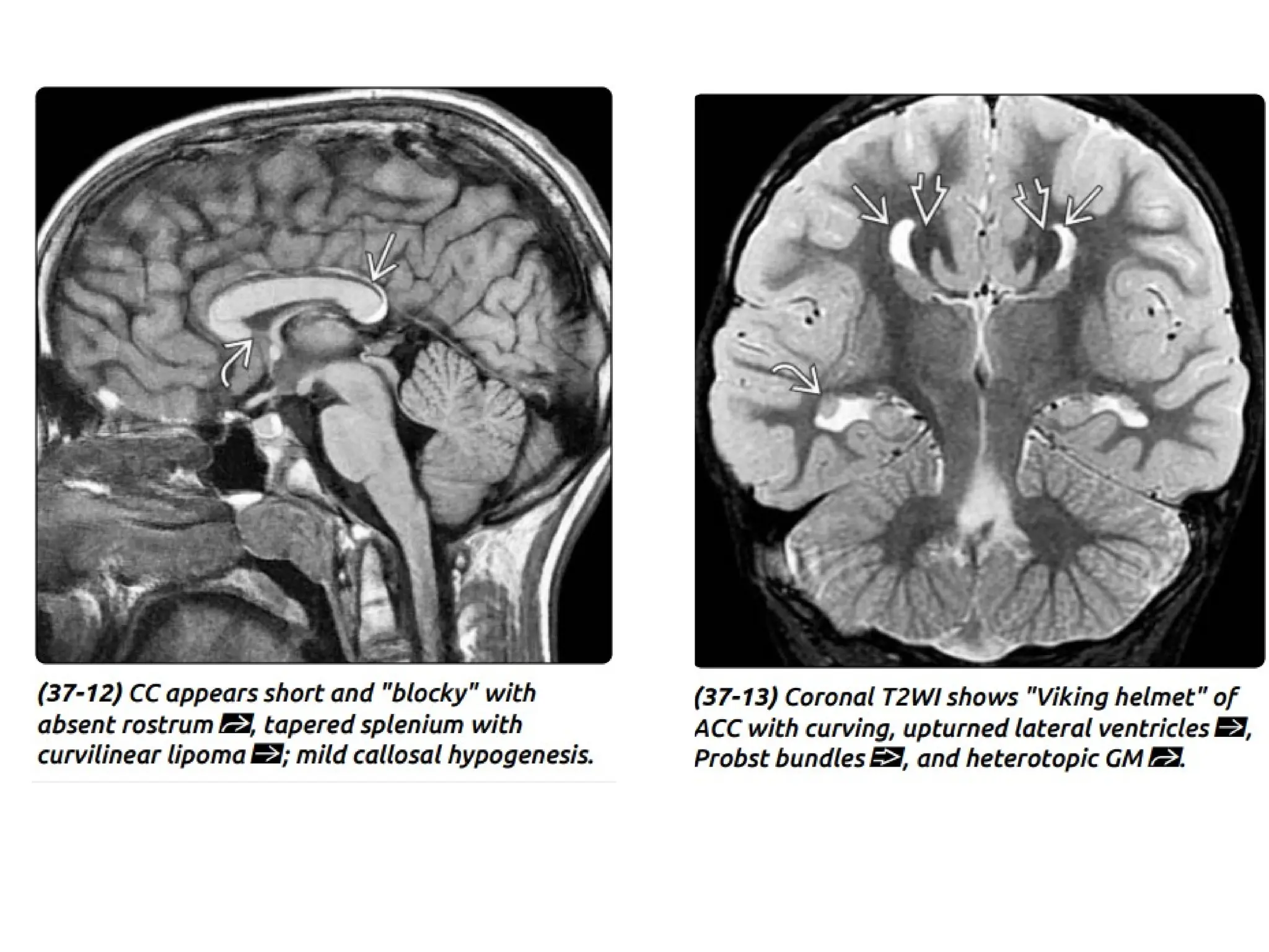 Malformations of Cortical Development.pptx
