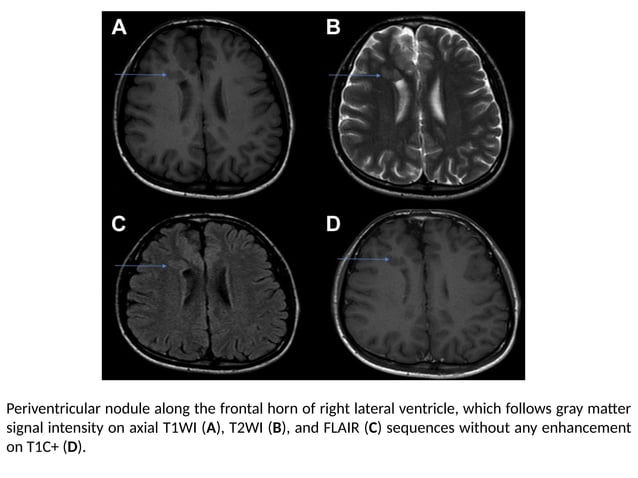 Malformations of Cortical Development.pptx