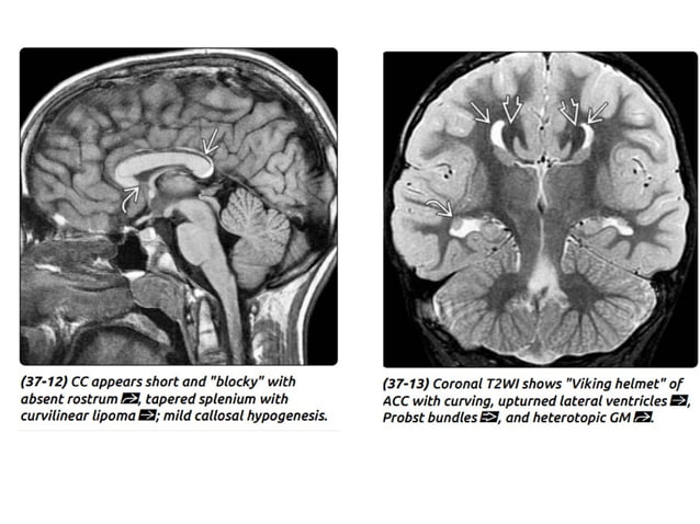 Malformations of Cortical Development.pptx